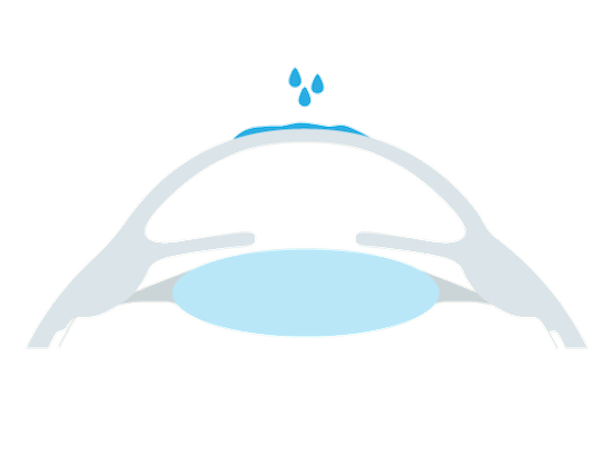 ICL lens implantation, EVO+ Phake lens EyeLaser Vienna Linz