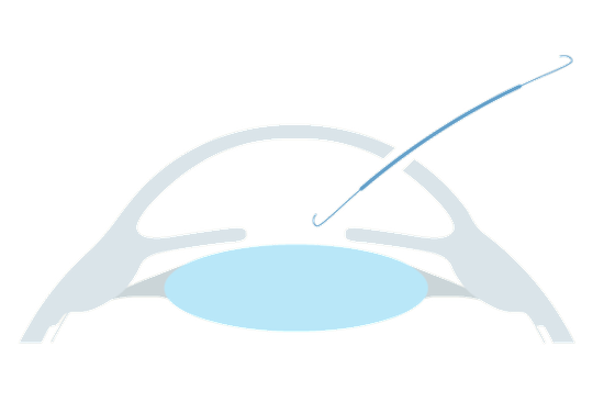 Phake Linsen ICL Implantation EyeLaser Wien Linz