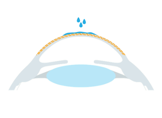 Trans-PRK laser eye surgery Vienna - Eyelaser Austria